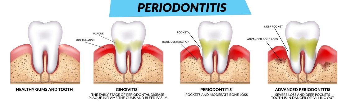 Periodontics - Schedule Periodontal Treatment In Buffalo Grove | North ...