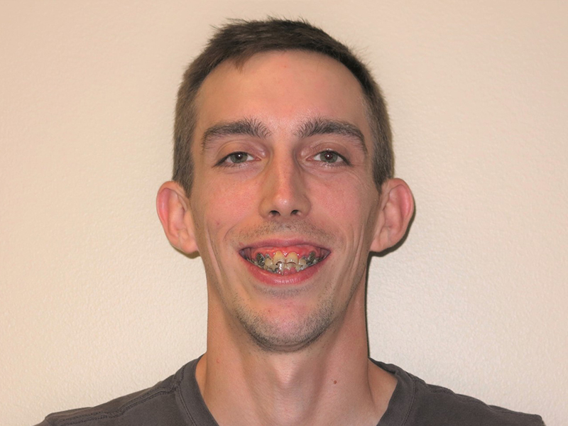 All-on-4® Full Arch Dental Implant | North Shore Smile Surgery